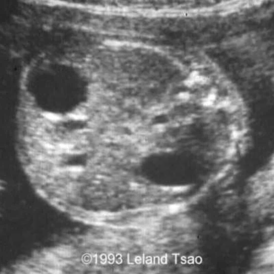 📃 Liver Cyst
