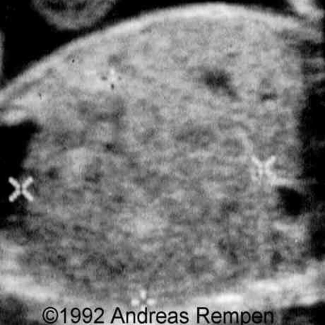📃 Mesoblastic nephroma