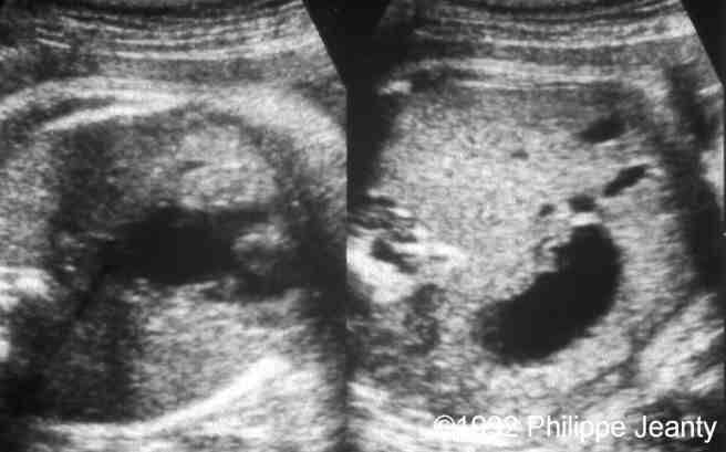 📃 Polysplenia syndrome