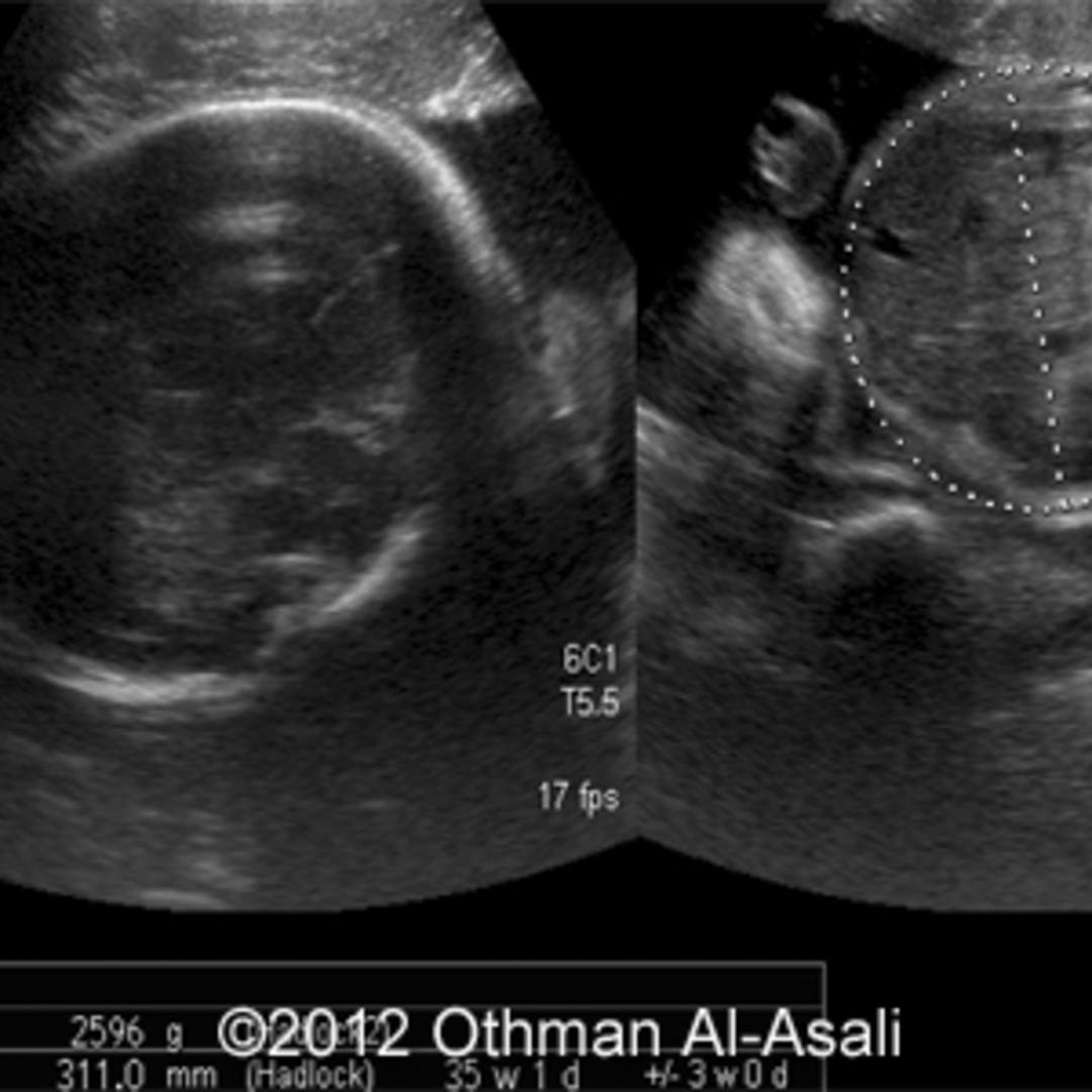 📃 Cavernous hemangioma of the chest with abnormal large foot