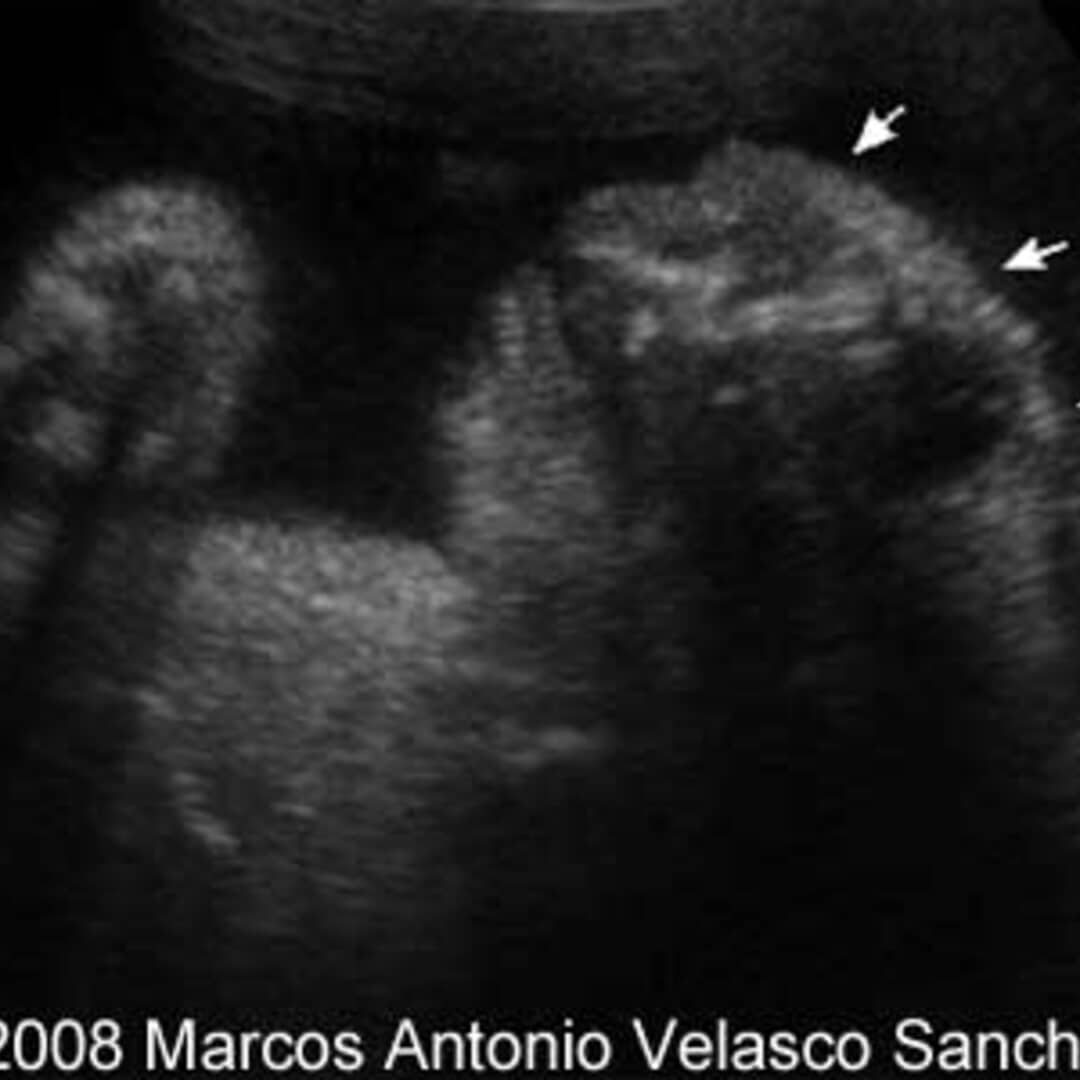 📃 Acrania - three cases