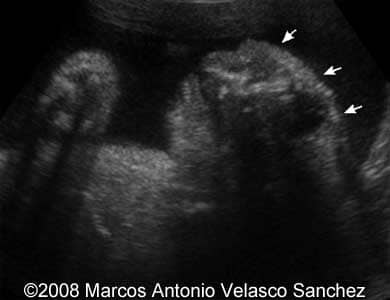 📃 Acrania - three cases