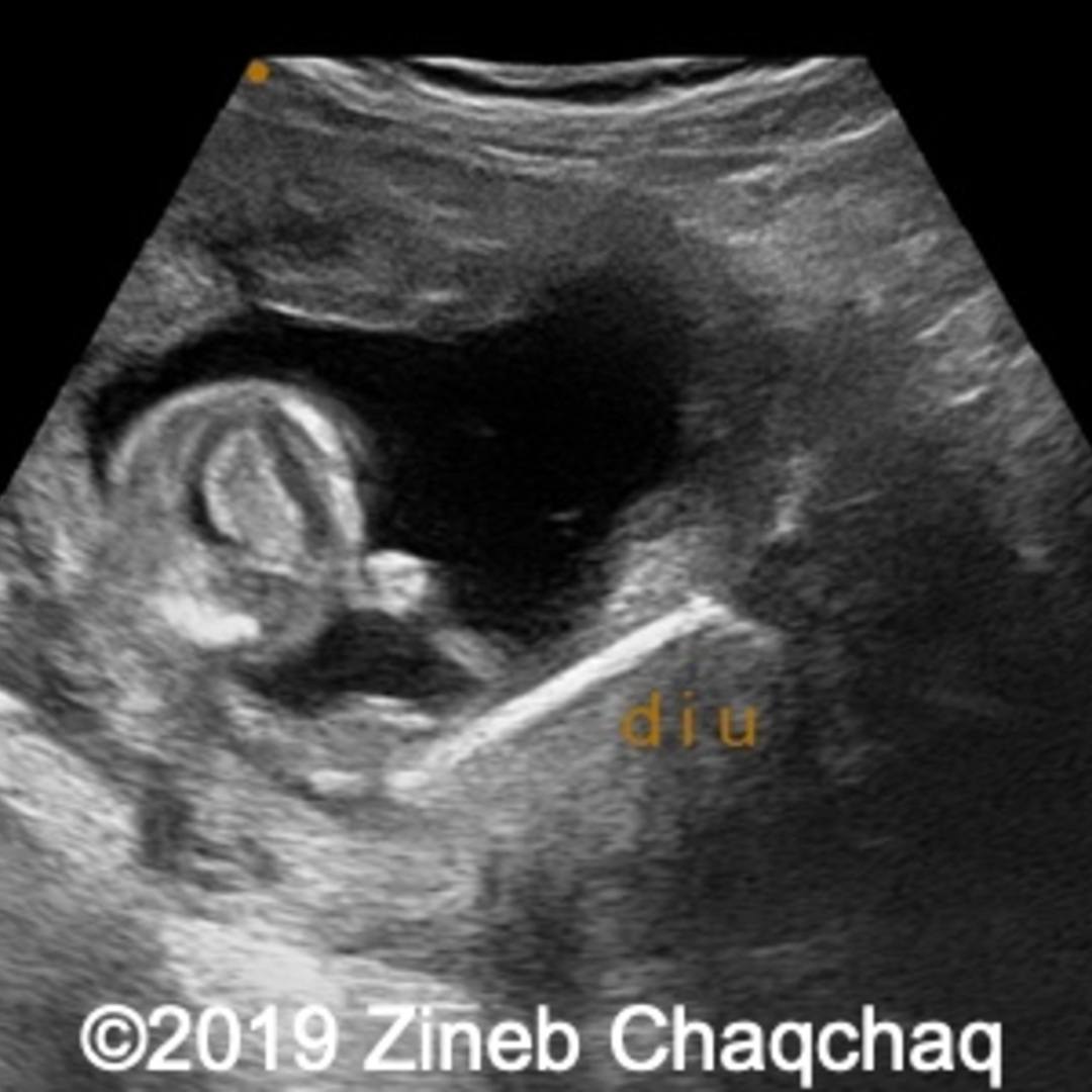 📃 IUD with pregnancy - Two Cases