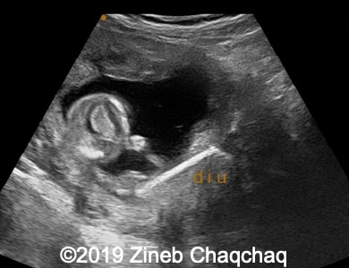 📃 IUD with pregnancy - Two Cases