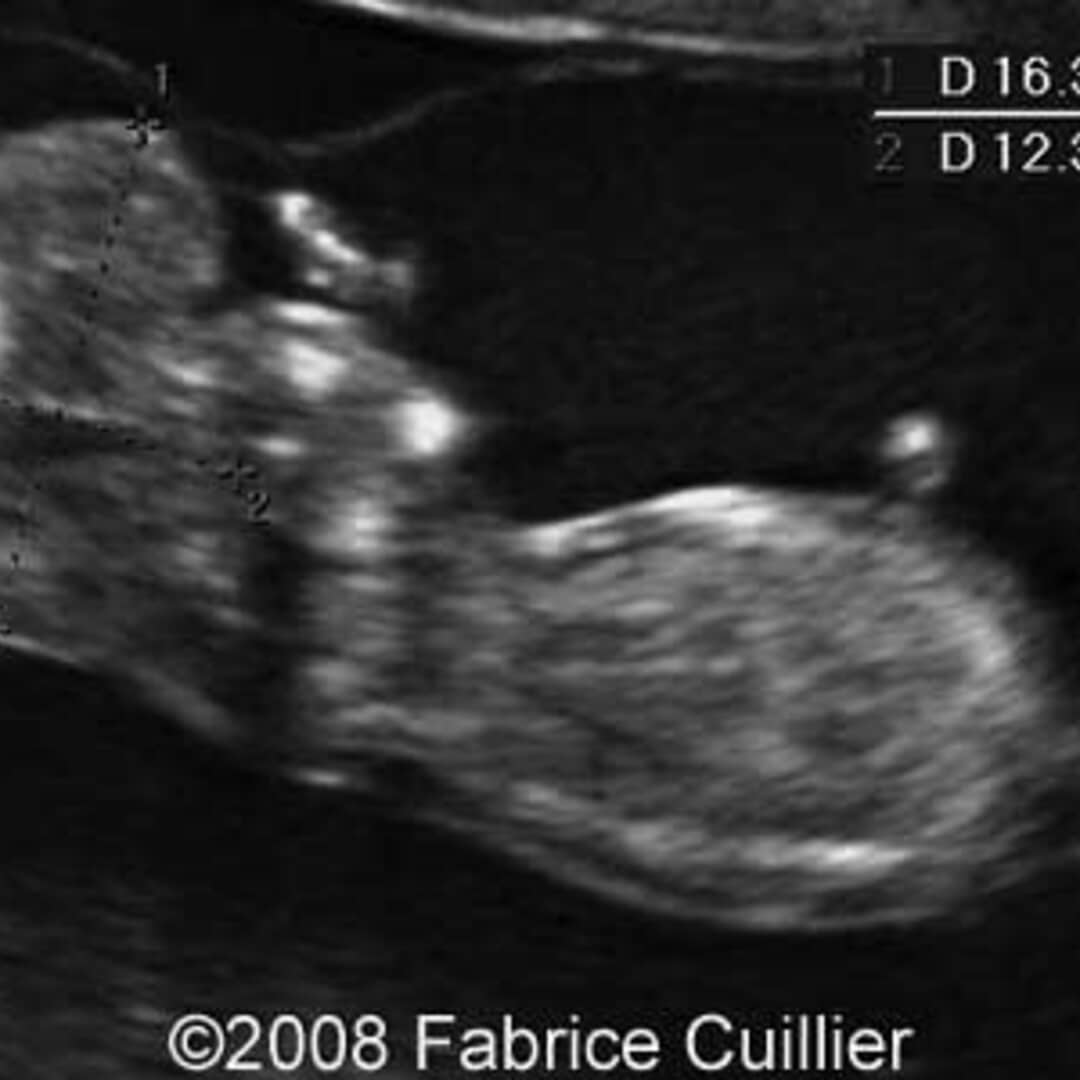 📃 Acrania, exencephaly – three cases