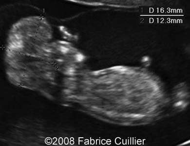 📃 Acrania, exencephaly – three cases