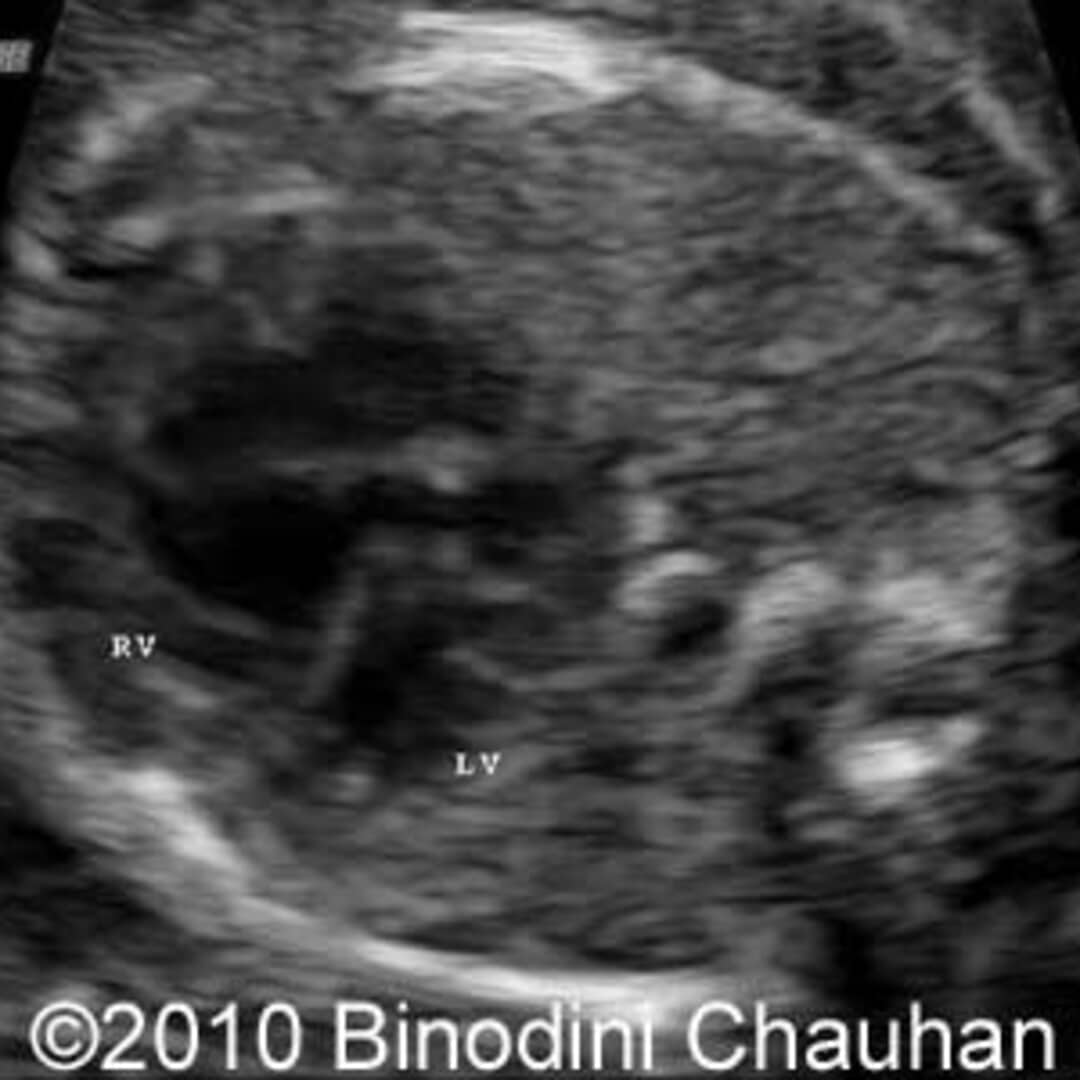 📃 Absent Pulmonary Valve Syndrome