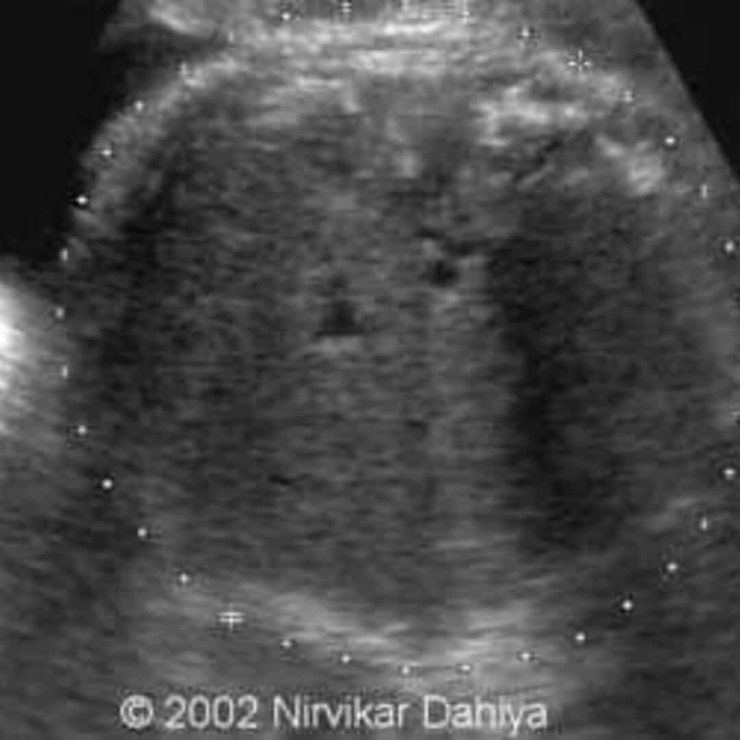 📃 Split-hand split-foot syndrome
