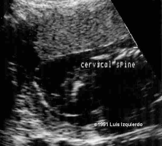 📃 Twins, acardiac, acephalus