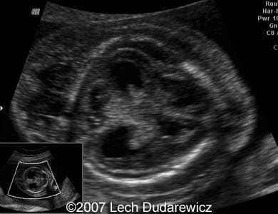 📃 TRAP syndrome: case report and perspectives of prenatal therapy