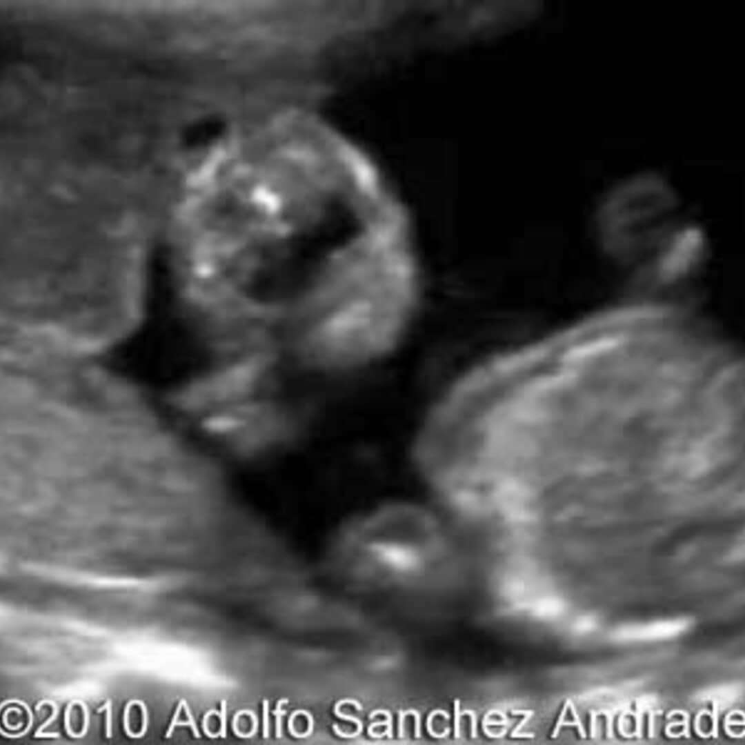 📃 Acrania with bilateral cleft