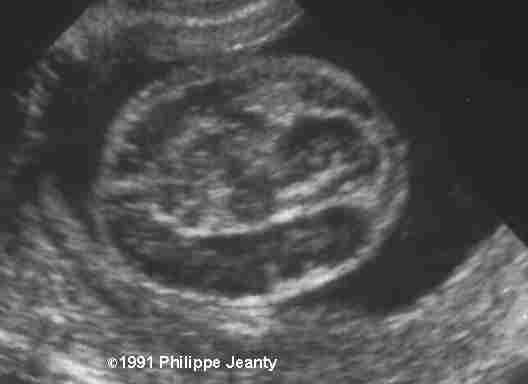 📃 Acrania: review of 13 cases