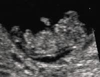📃 Anencephaly