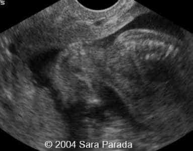 📃 Anencephaly