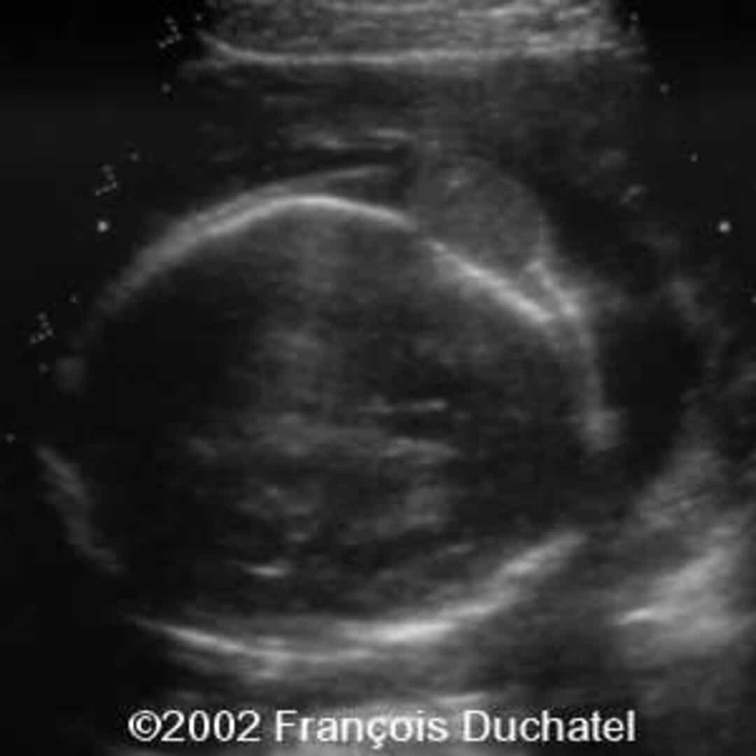 📃 Venous and capillary angioma