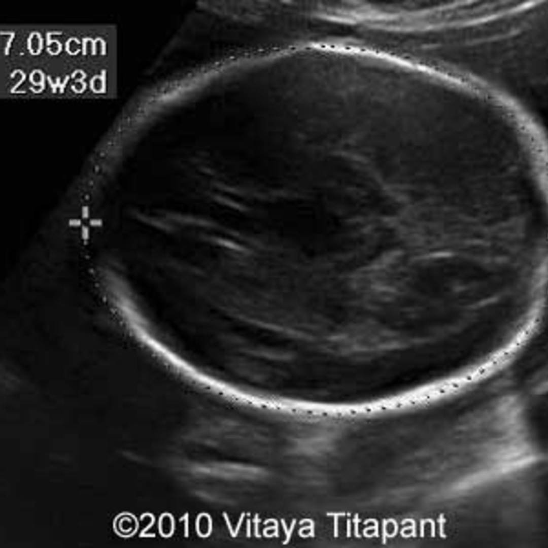 📃 Arachnoid Cyst
