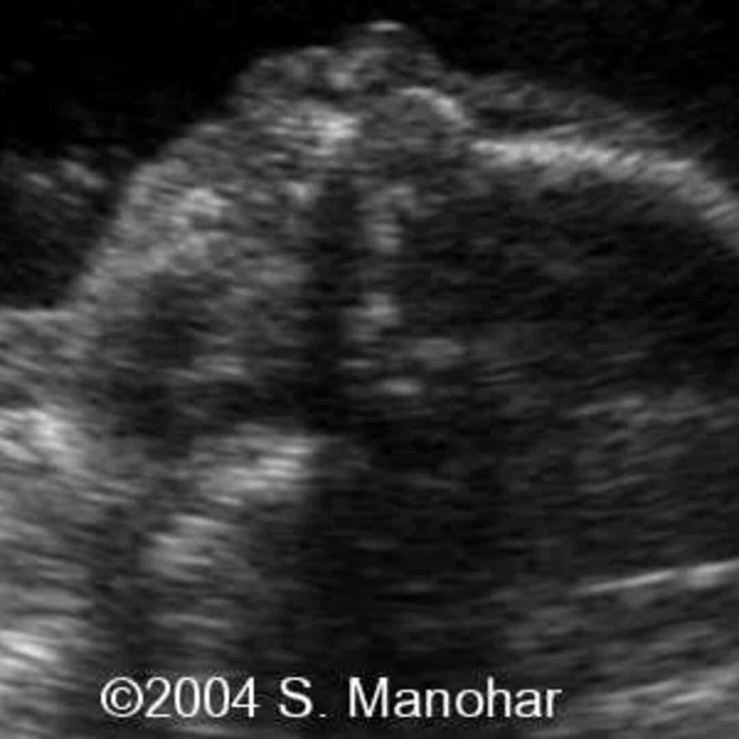 📃 Arthrogryposis multiplex congenita