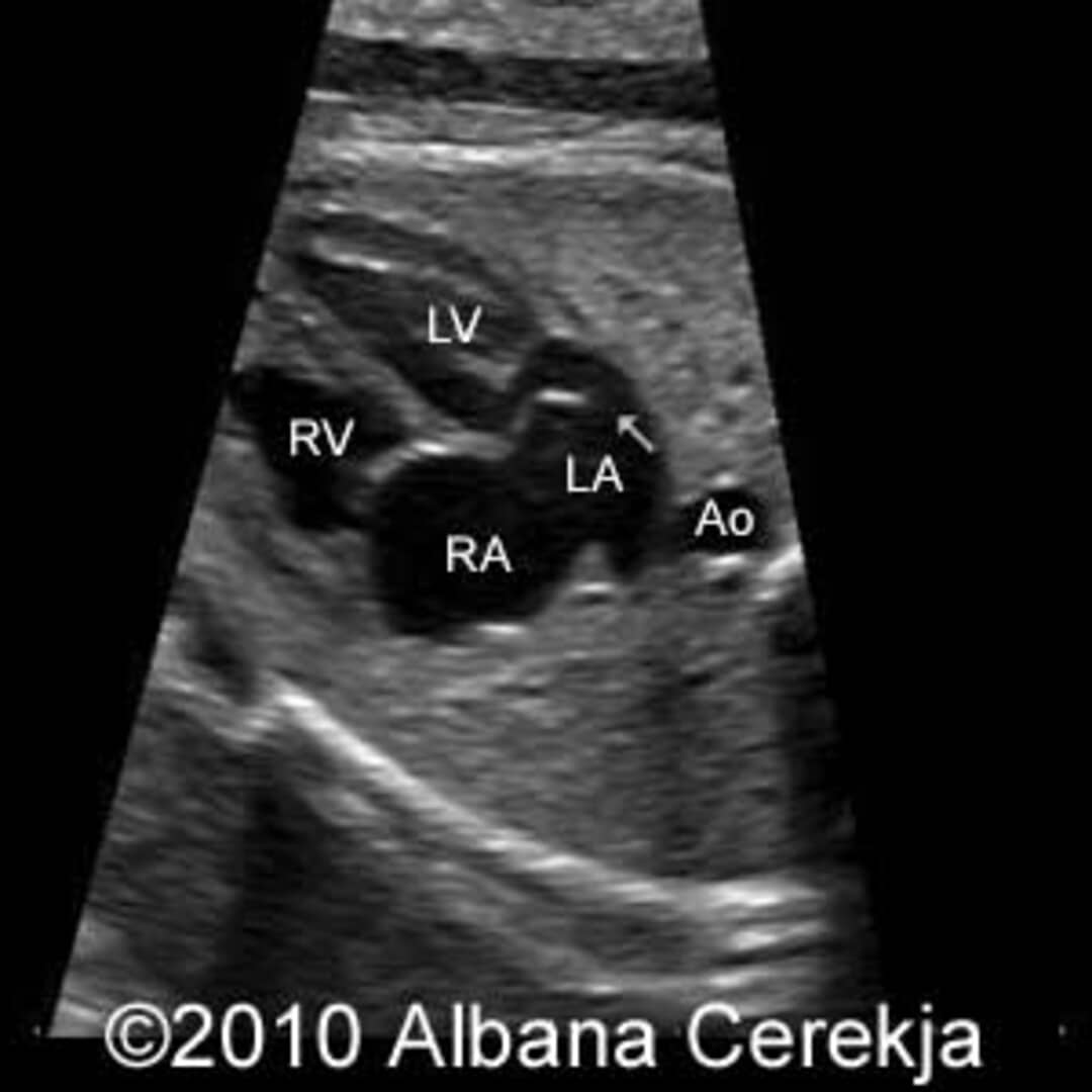 Atrial Septal Defect Ultrasound