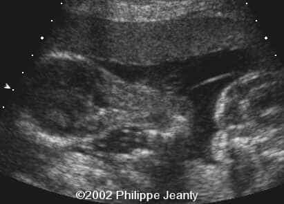 📃 Size-discordant twins