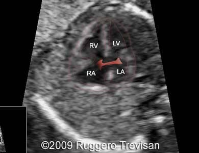 Endocardial Cushion Defect Ultrasound