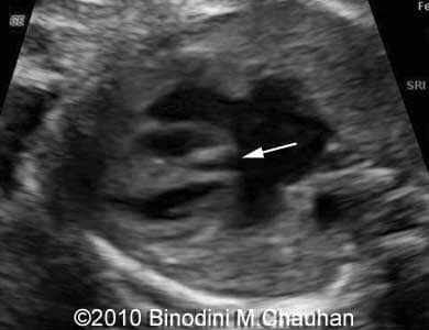 📃 Incomplete atrioventricular septal defect