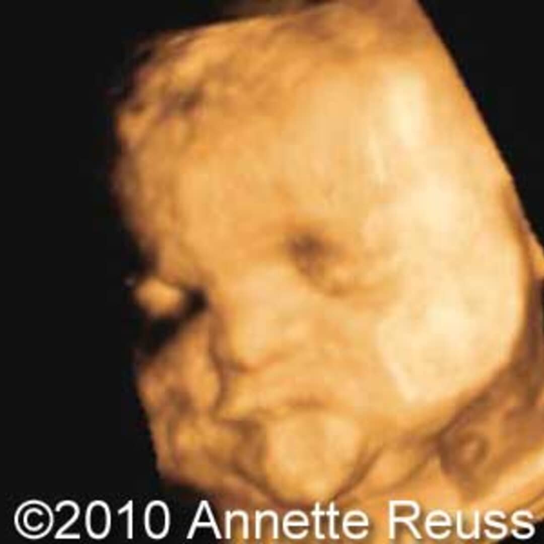 📃 Beckwith-Wiedemann syndrome