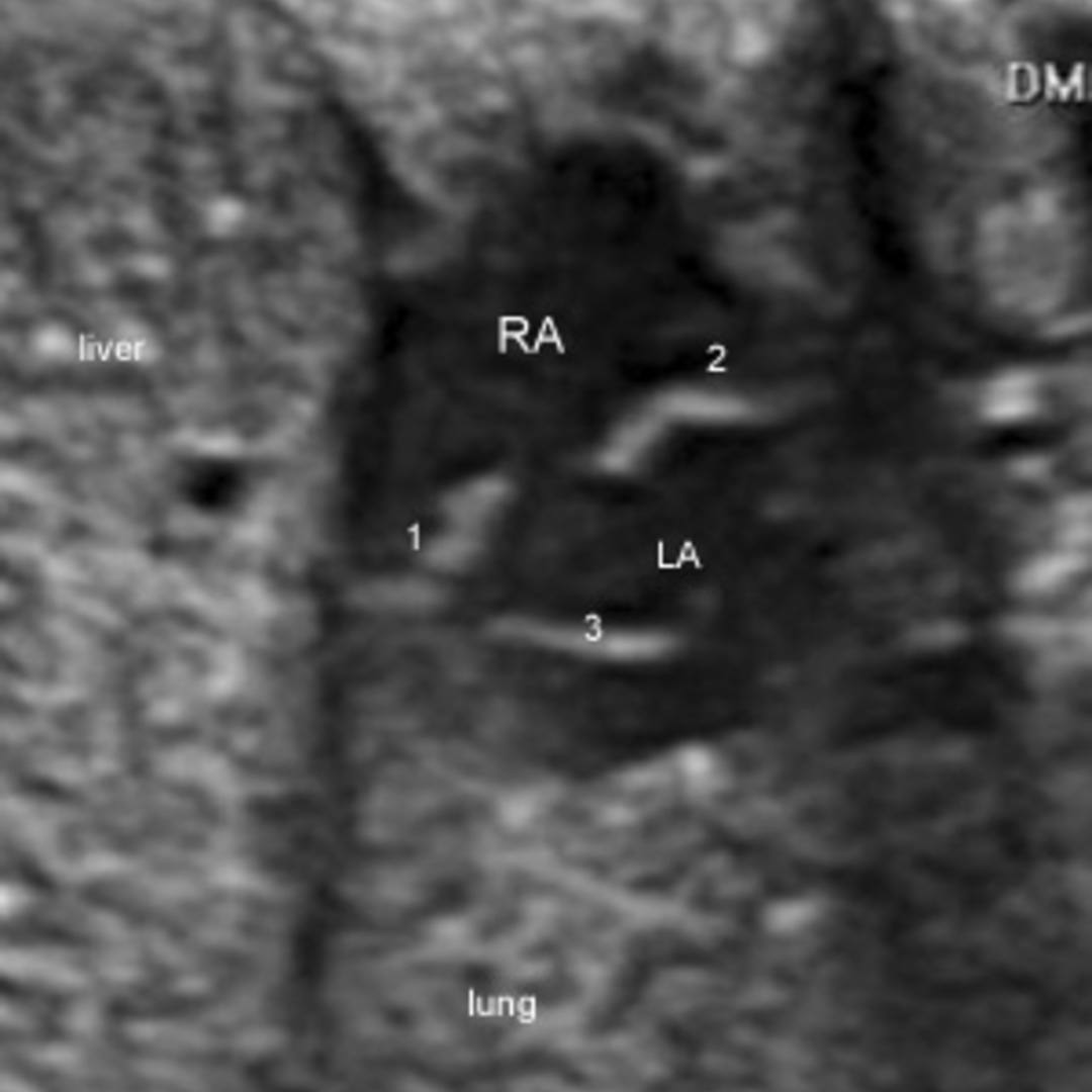 📃 Atrial short-axis view