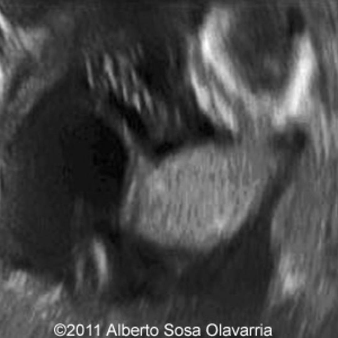 📃 A Case of bladder exstrophy and new theory on its natural history