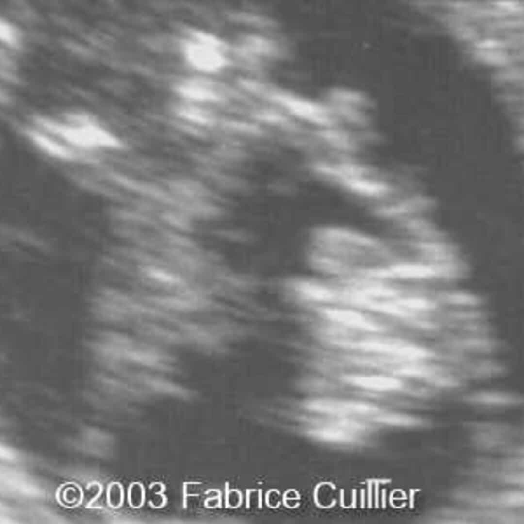 📃 Amniotic Band Syndrome 1st Trimester