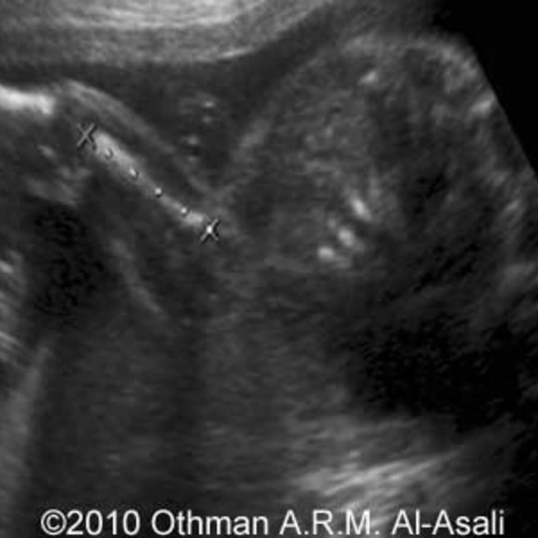 Campomelische Dysplasie Echografie