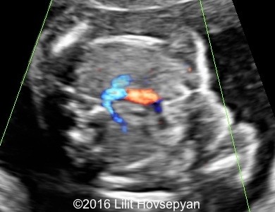 📃 Aberrant right subclavian artery (ARSA)