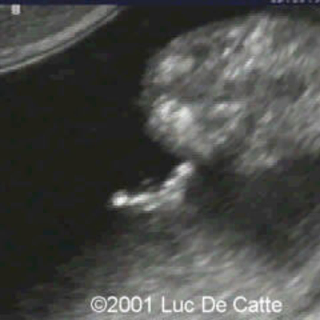 📃 Split-hand split-foot syndrome