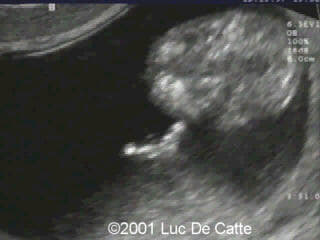 📃 Split-hand split-foot syndrome