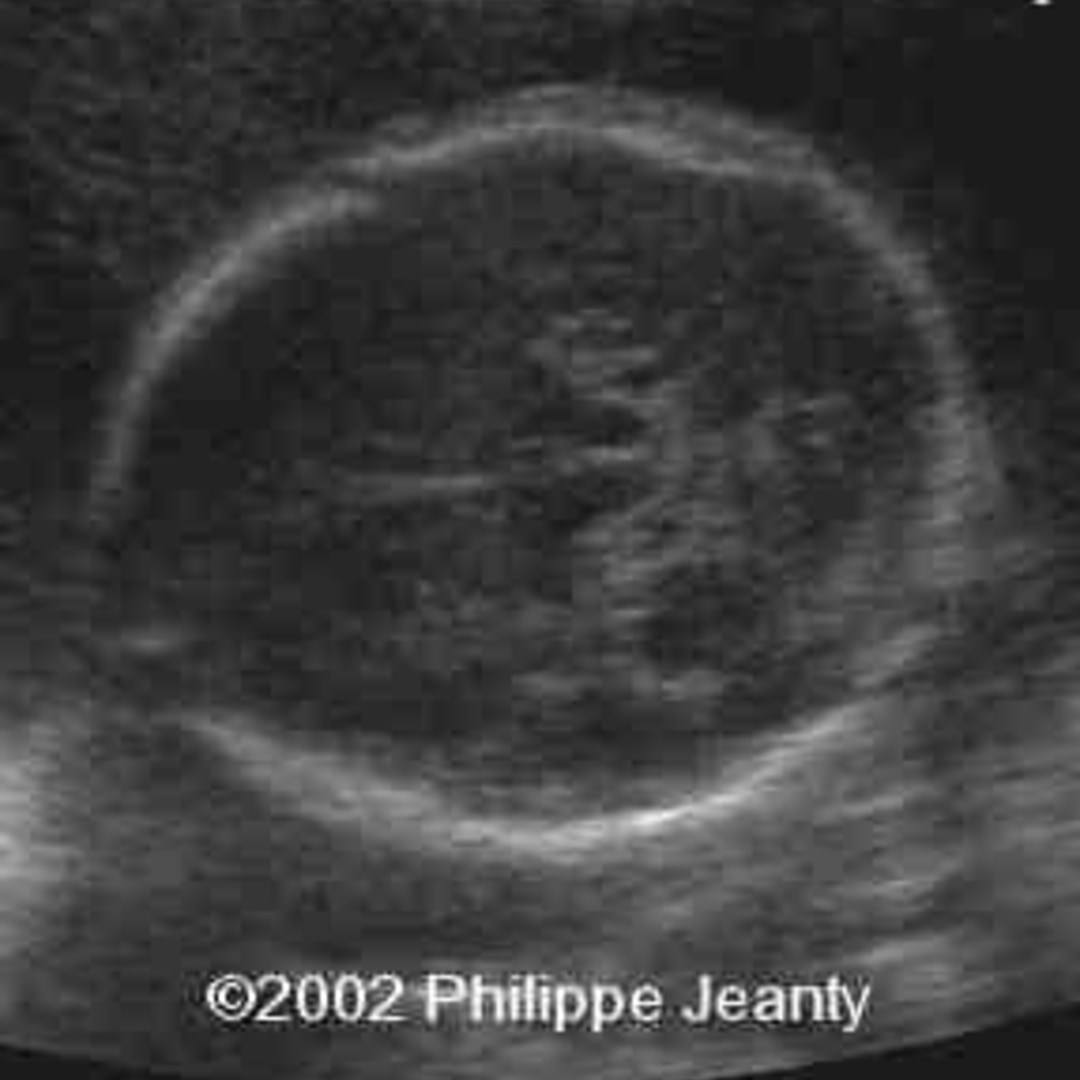 Septo Optic Dysplasia Ribbon