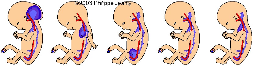 📃 Cystic hygroma, anterior