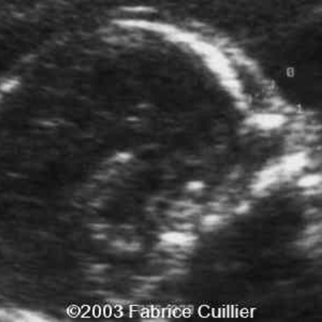 📃 Pallister Killian syndrome