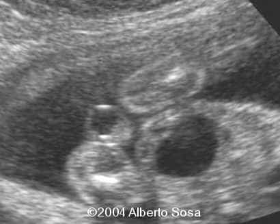 📃 Megalourethra with horseshoe kidney