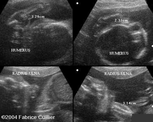 📃 Kniest syndrome