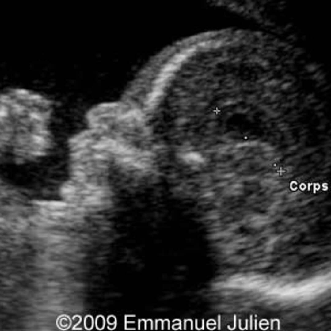 📃 CHARGE syndrome