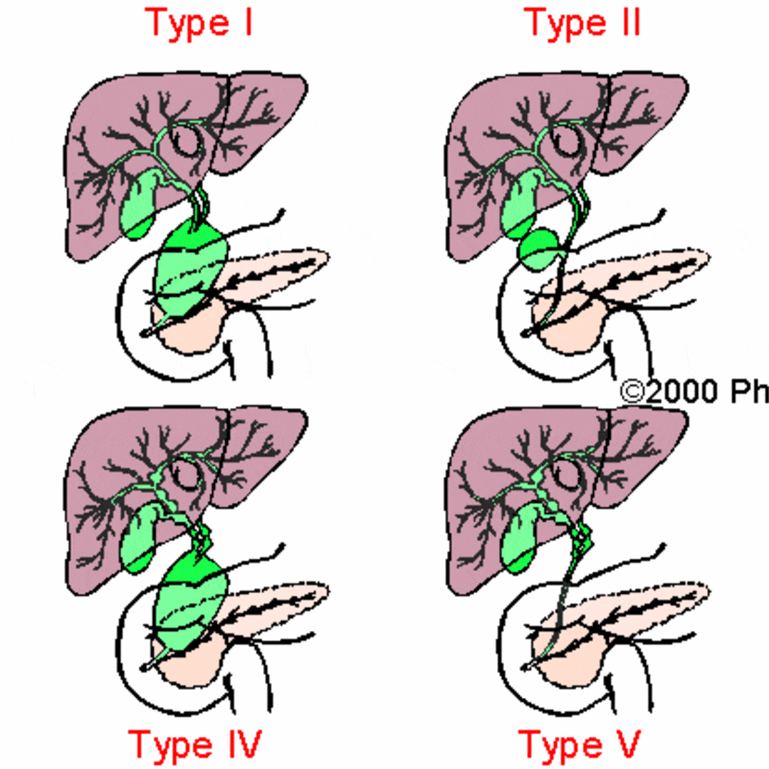 📃 Choledochal cyst