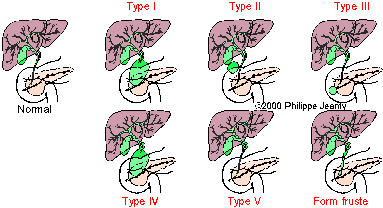 📃 Choledochal cyst
