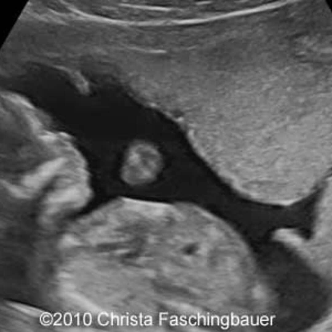 📃 Circumvallate placenta