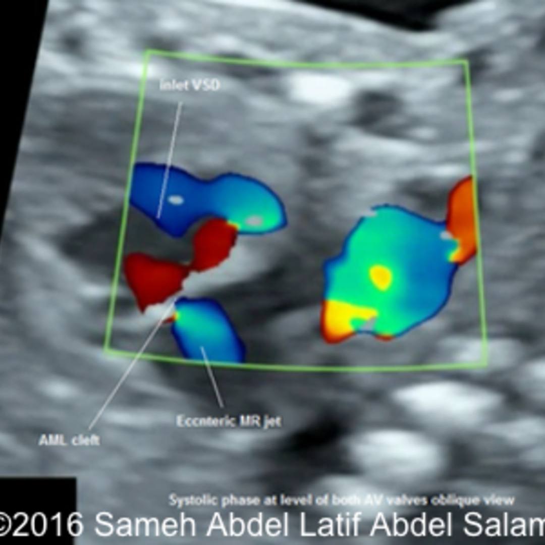 📃 Tetralogy of Fallot with clefting in anterior leaflet of mitral valve