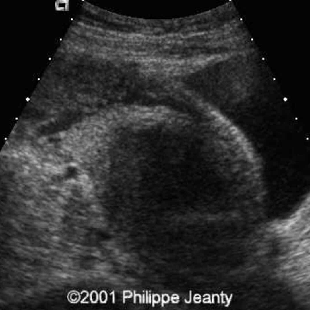 📃 Uterine myoma and pregnancy