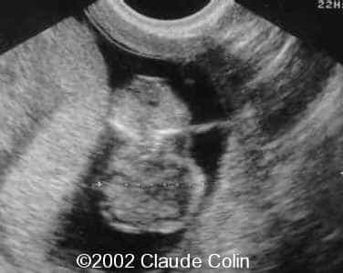 📃 Schisis-association