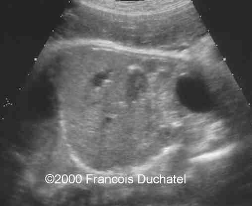 📃 Hepatic capsule calcification, idiopathic