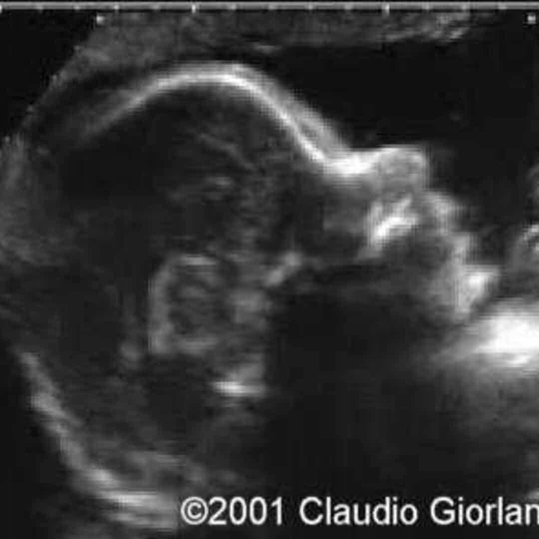 📃 Crouzon syndrome