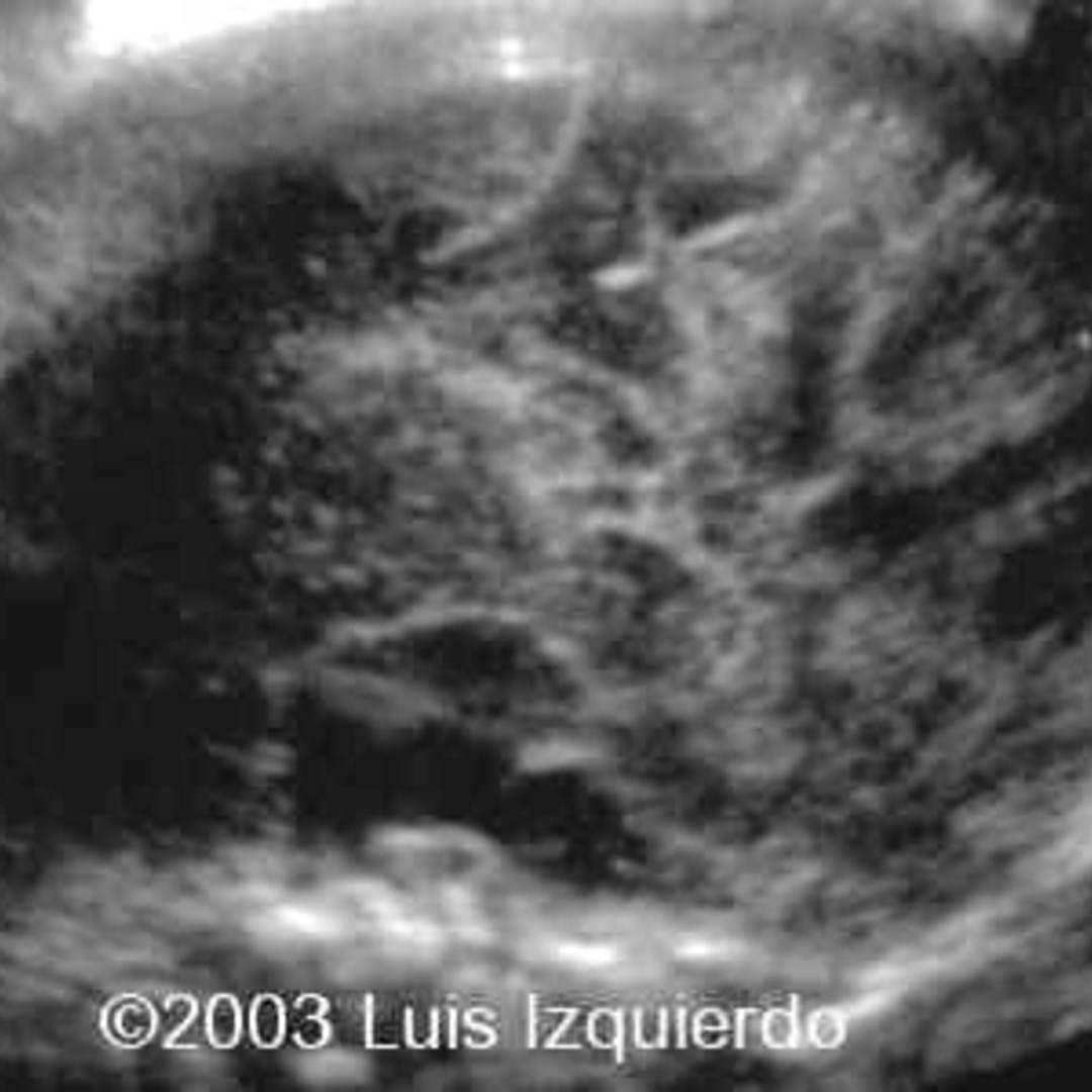 📃 Arachnoid Cyst Causing Obstructive Hydrocephalus