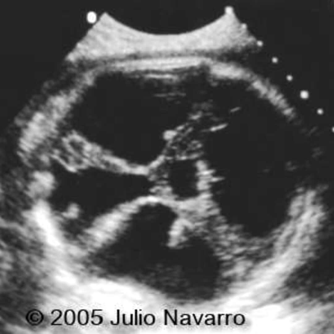 dandy walker malformation gross