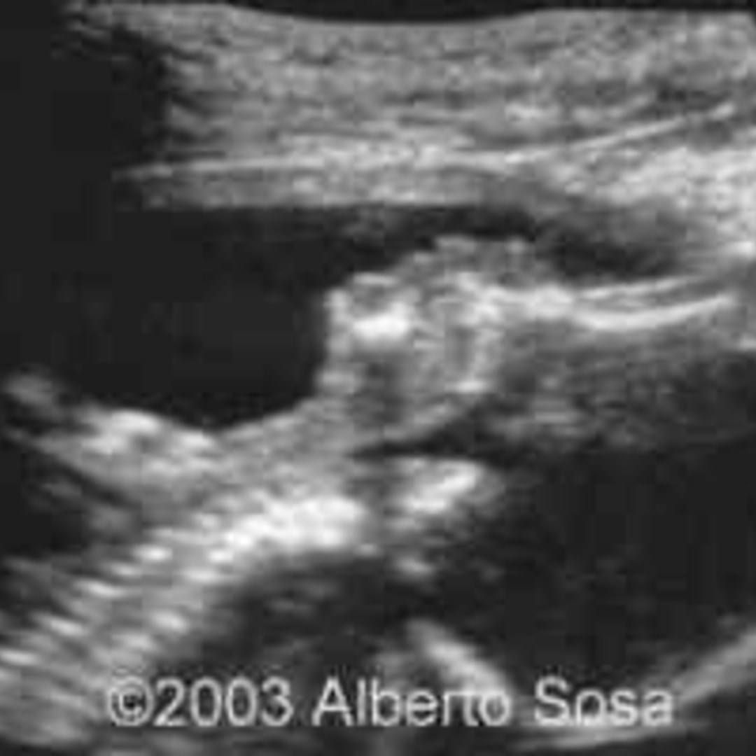 📃 Femoral hypoplasia - unusual facies syndrome